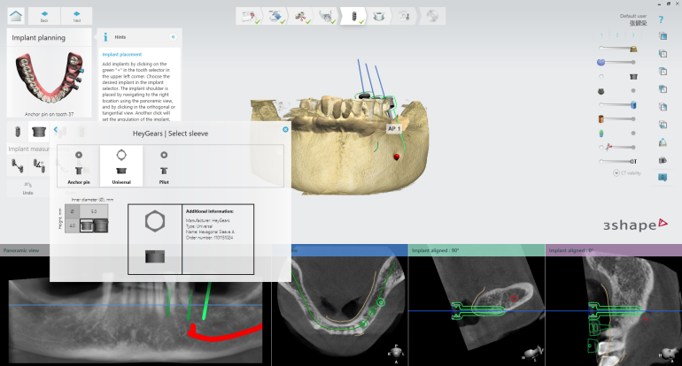 HeyGears Presets with 3Shape and exocad: Optimize Your Digital ...