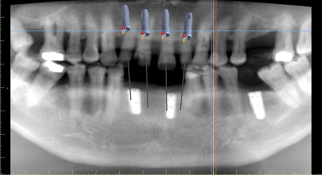 Dental Implants for A Patient with Advanced Periodontal Disease