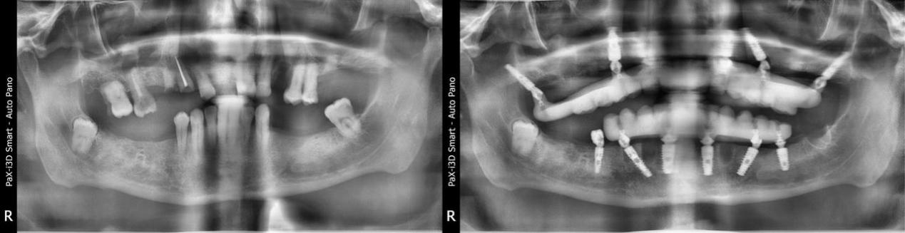 Patient Case Study | Dr. Jedediah Wooldridge Producing Full-arch Dentures