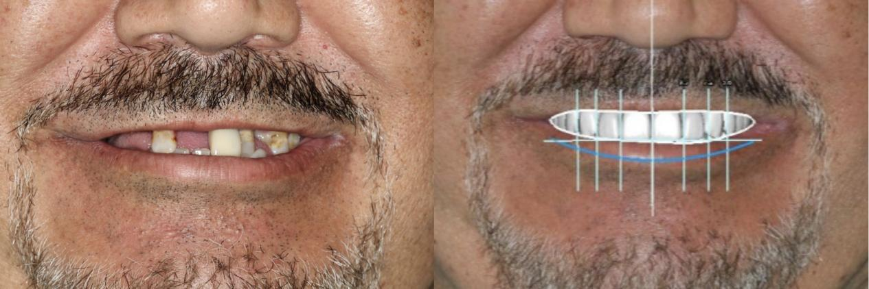 Patient Case Study | Dr. Jedediah Wooldridge Producing Full-arch Dentures